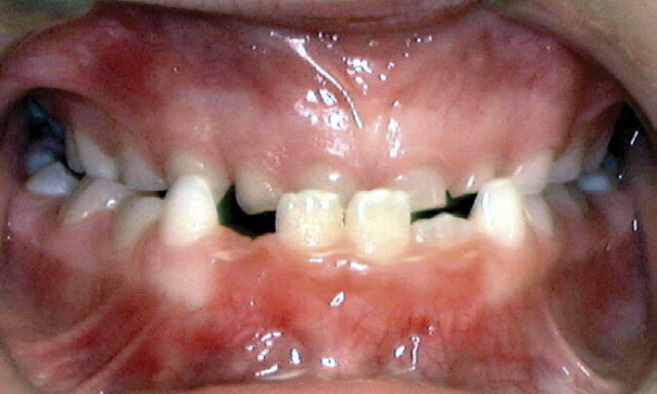 Common Orthodontic Problems Marietta Roswell GA